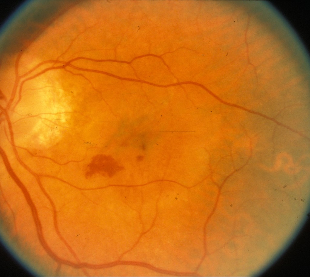 Macular Degeneration | ARMD