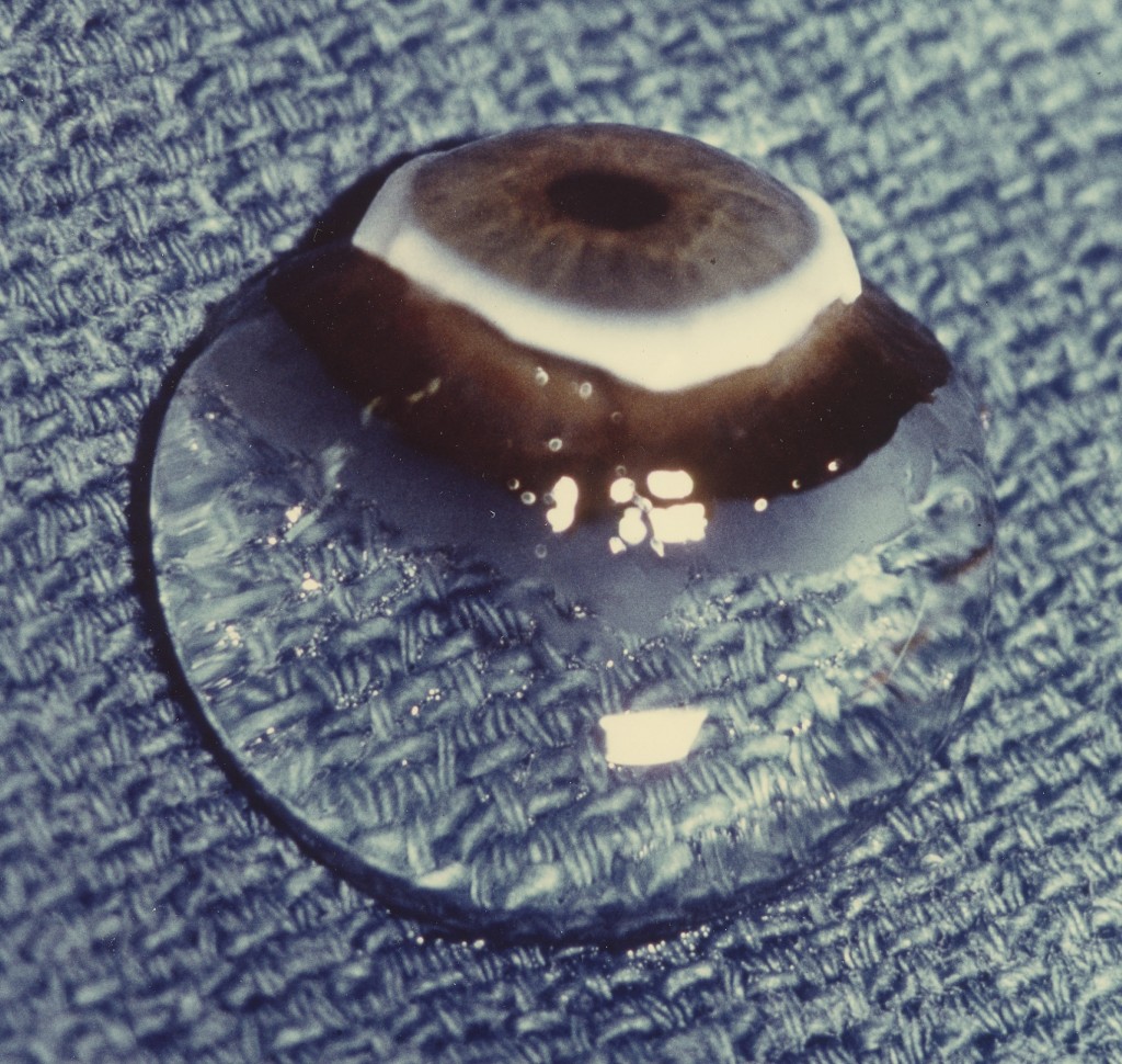What is a posterior vitreous detachment (PVD)