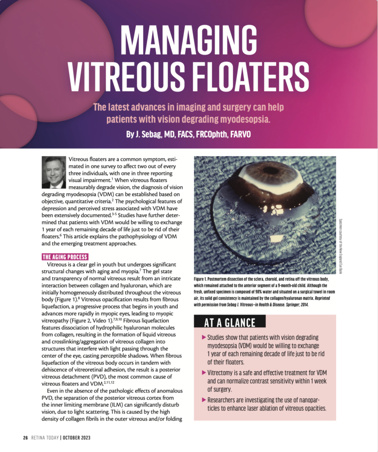 ARTICLE: Managing Vitreous Floaters - Retina Specialists Huntington ...